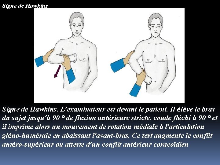 Lpaule douloureuse pathologie de la coiffe des rotateurs