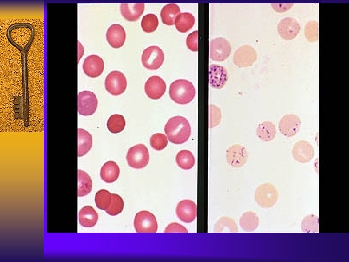 HEMOLYTIC ANEMIA EXTRACORPUSCULAR DEFECTS DR SWAMY C R