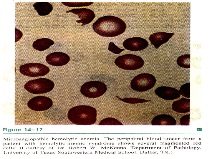 HEMOLYTIC ANEMIA EXTRACORPUSCULAR DEFECTS DR SWAMY C R