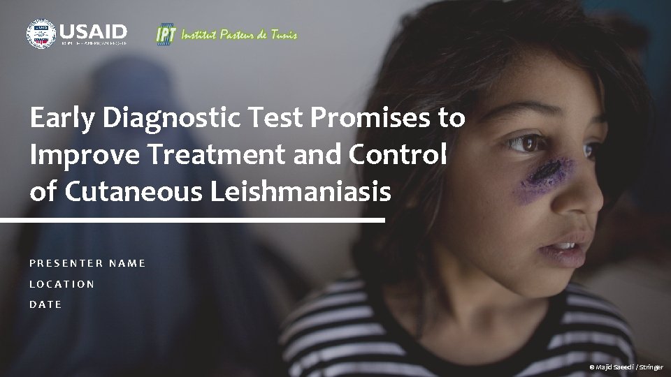Early Diagnostic Test Promises to Improve Treatment and