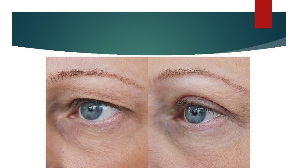 Botox Brow Lift for Hooded Eyes in Dubai
