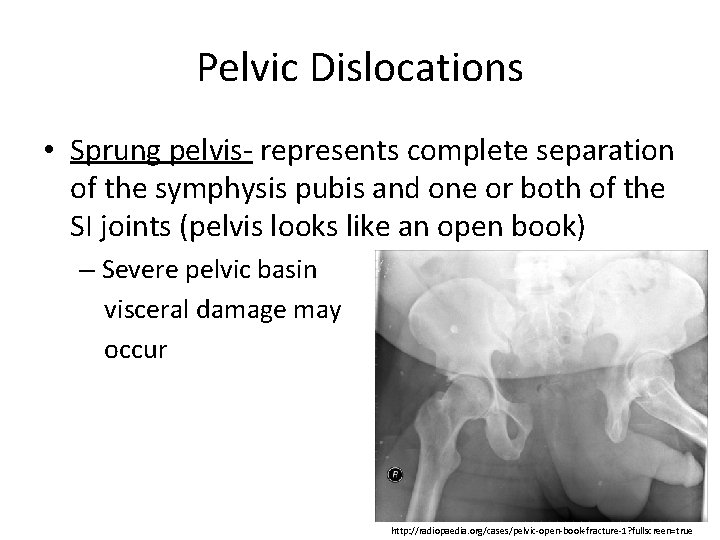 Fractures and Dislocations of the Pelvis Sacral Fractures