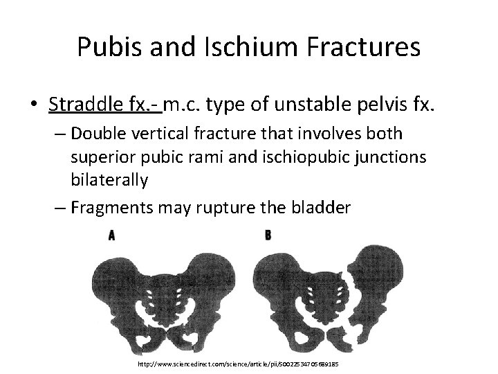Fractures and Dislocations of the Pelvis Sacral Fractures