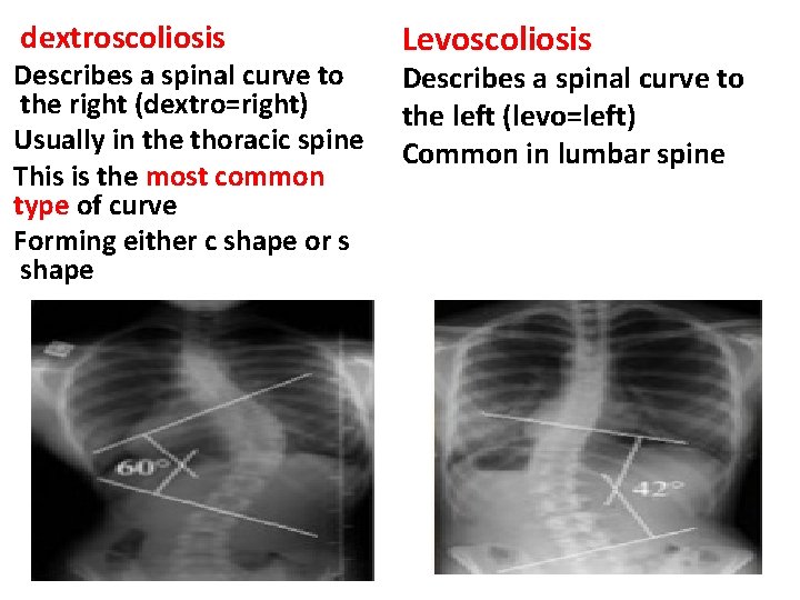 scoliosis outlines 1 normal vertebral curvature 2 Definition