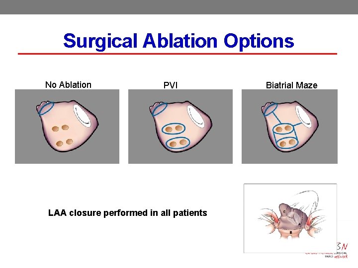 SURGICAL ABLATION OF ATRIAL FIBRILLATION DURING MITRAL VALVE