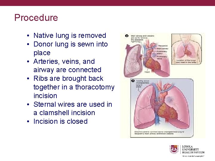 Lung Transplant From Referral Through Recovery Daniel Dilling