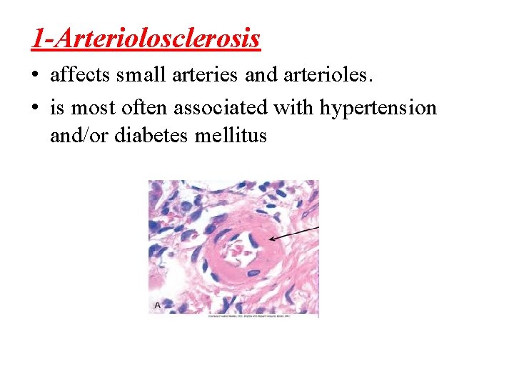 Normal blood vessels A artery V vein ARTERIOSCLEROSIS