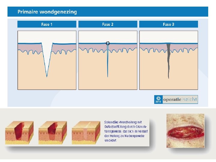 wonden schaafwond scheurwond Rafelige wondranden Half vastzittende huid