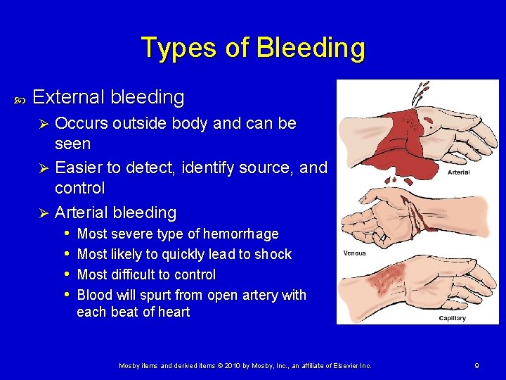 Chapter 11 Bleeding Soft Tissue Wounds and Shock