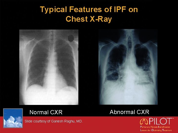 Early and Accurate Diagnosis of Idiopathic Pulmonary Fibrosis