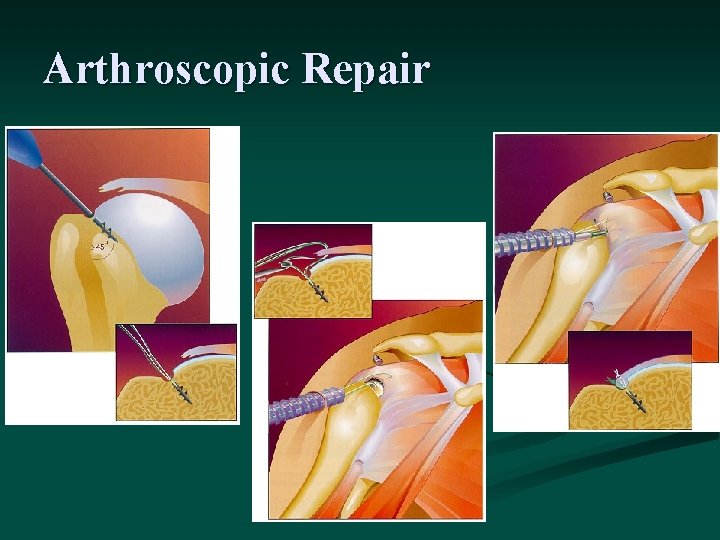 Rotator Cuff Tears Thomas J Kovack DO Rotator