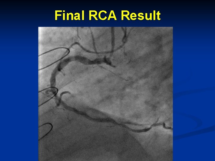Cath lab Nightmares My Worst Complication CRT 2012