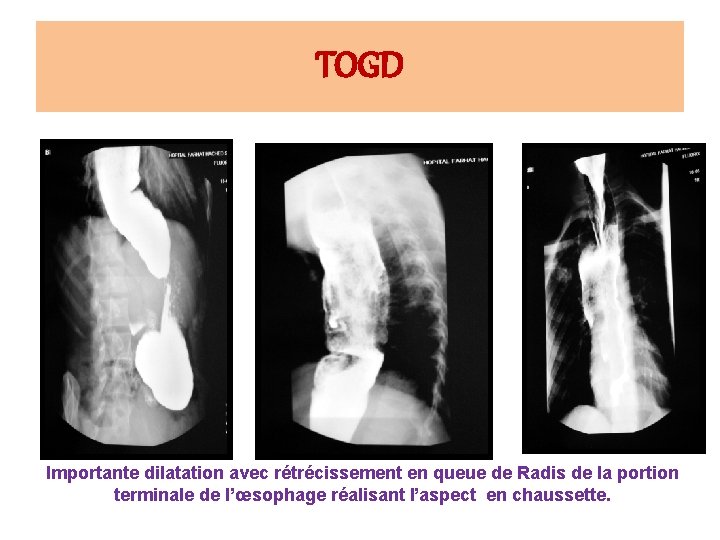 Pneumopathie abcde rvlatrice dune achalasie de lsophage Aissa