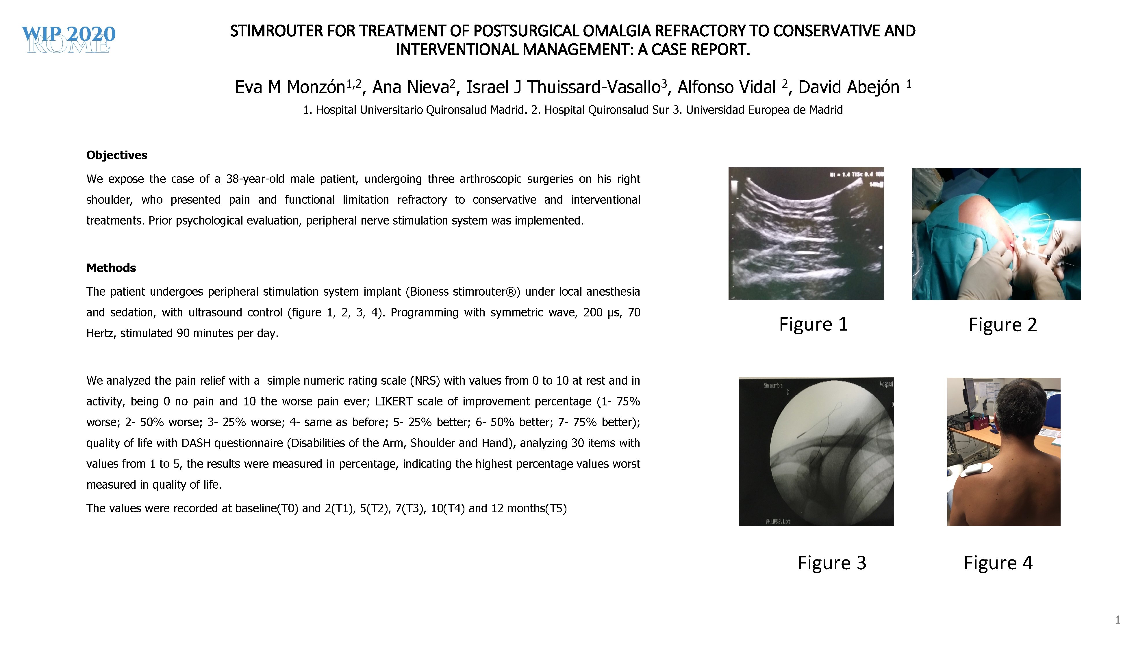 STIMROUTER FOR TREATMENT OF POSTSURGICAL OMALGIA REFRACTORY TO