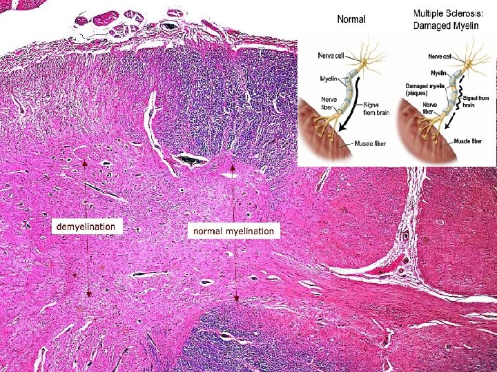 Primary Diseases of Myelin Dr Nesreen Bataineh MD
