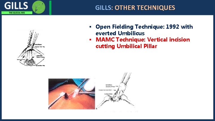 I GILLS PNEUMOPERITONEUM ACCESS AND PATHOPHYSIOLOGY OF PNEUMOPERITONEUM