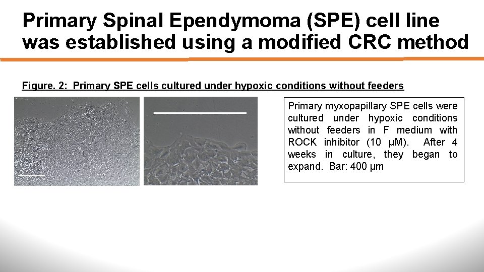 Novel CellBased Models of Pediatric Spinal Ependymoma 1