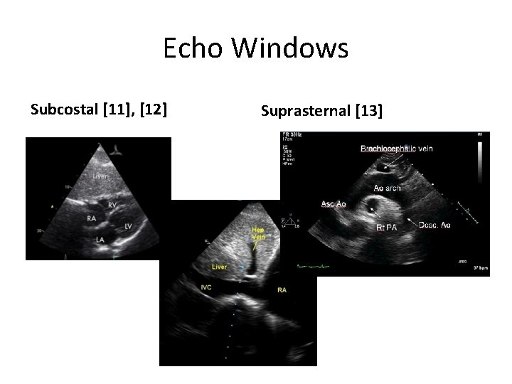 Echocardiogram Dr Emily Player 2 D Echo Structural