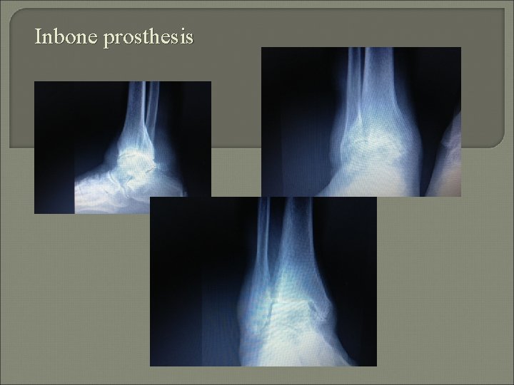 Ankle Arthroplasty Can the Ankle Joint be Replaced