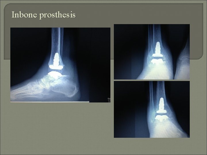 Ankle Arthroplasty Can the Ankle Joint be Replaced