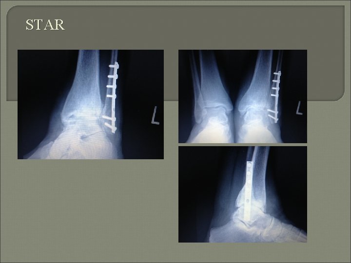Ankle Arthroplasty Can the Ankle Joint be Replaced