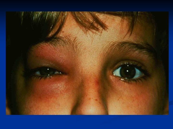 Types n Preseptal Cellulitis n Orbital Cellulitis 1