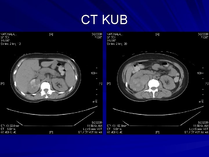 Endoscopic management of iatrogenic ureteric strictures Vijayanand B