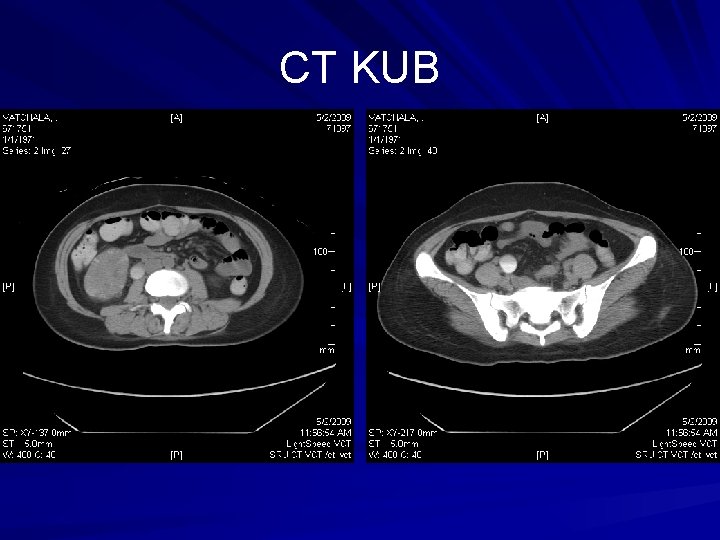 Endoscopic management of iatrogenic ureteric strictures Vijayanand B