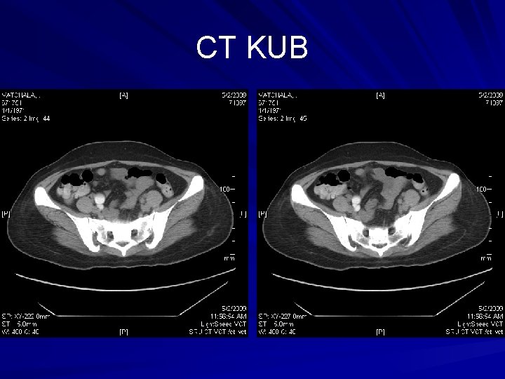 Endoscopic management of iatrogenic ureteric strictures Vijayanand B