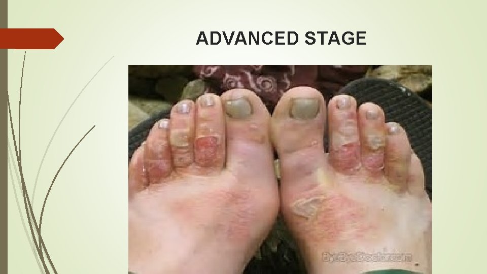Trench Foot CAUSES OF TRENCH FOOT v Prolonged