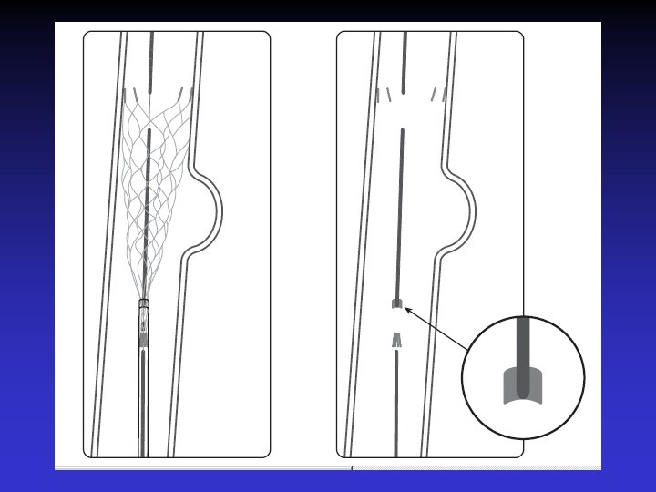 Embolizacin de aneurismas asistida con stent Enterprise Experiencia