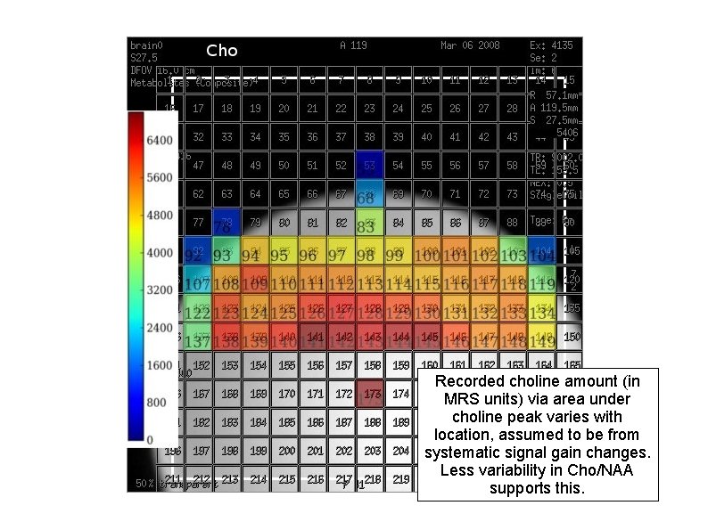 DWMRI and MRS to Differentiate Radiation Necrosis and