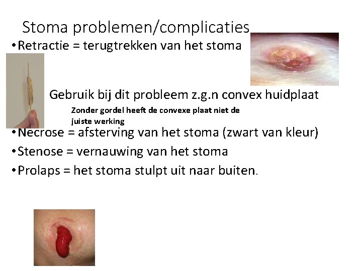 Leerdoelen stoma zorg Je kent de verschillende soorten