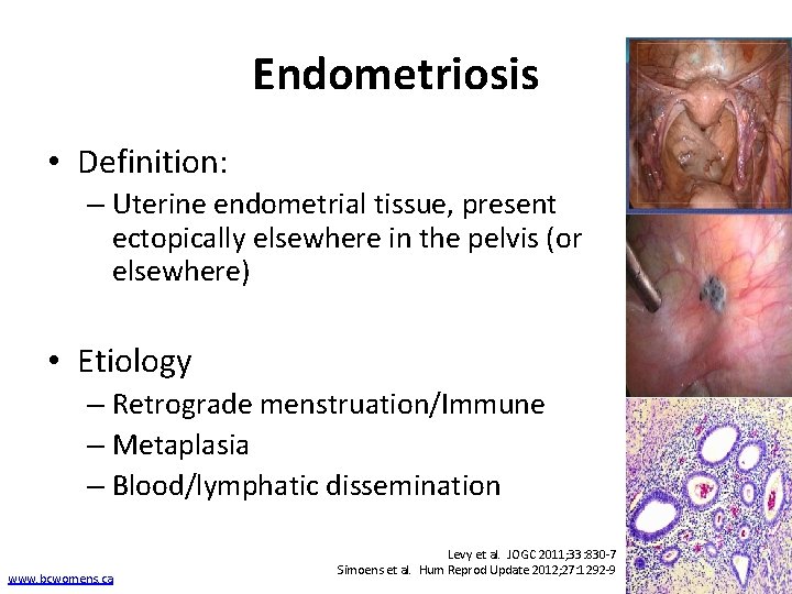 Endometriosis Cancer Association Paul Yong MD Ph D