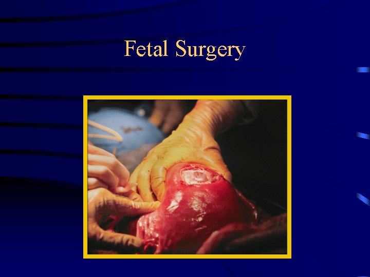 Vanderbilt University Department of Biomedical Engineering Fetal Stabilizer