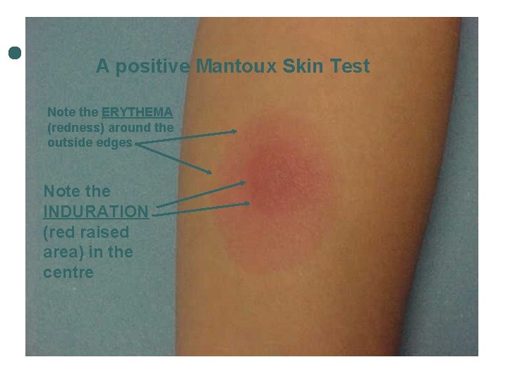 Intradermal injections Interpretation of Mantoux Tests Intradermal ...