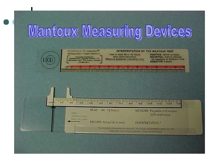 Intradermal injections Interpretation of Mantoux Tests Intradermal ...