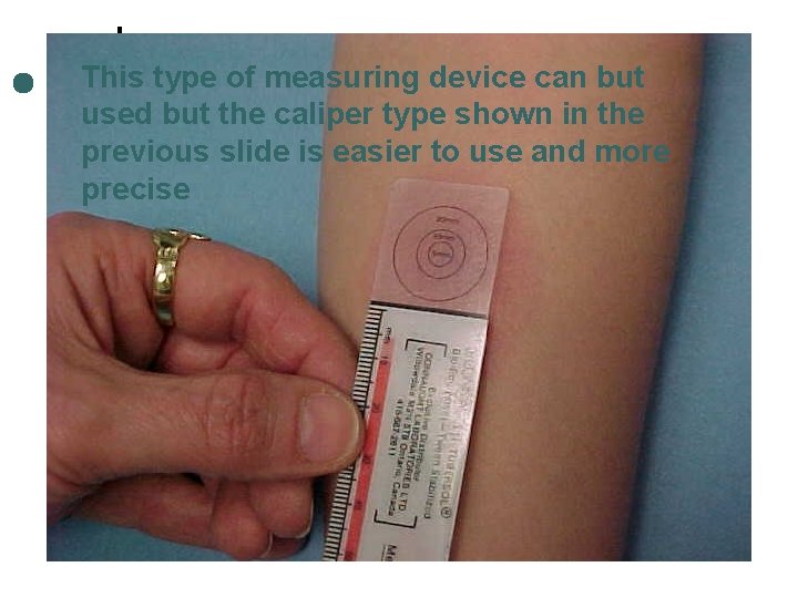 Intradermal injections Interpretation of Mantoux Tests Intradermal ...