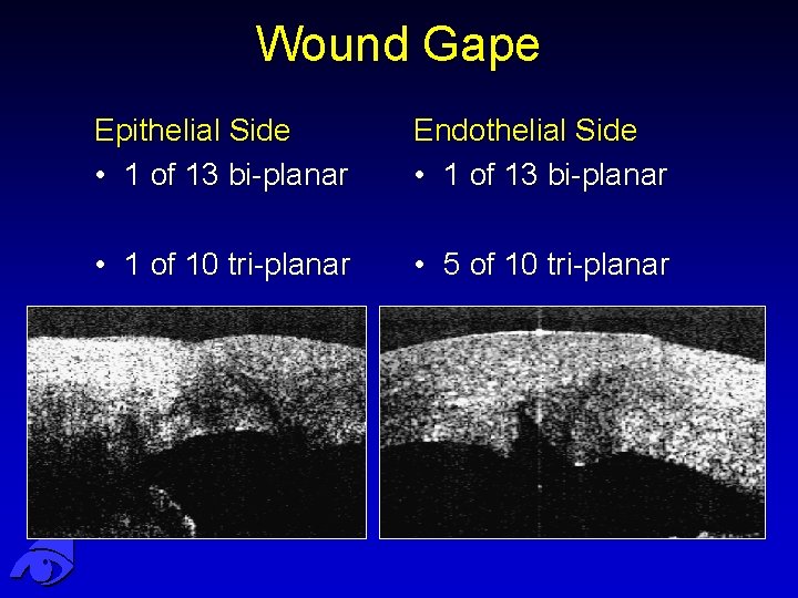 Analysis of Clear Corneal Incision Architecture with Anterior