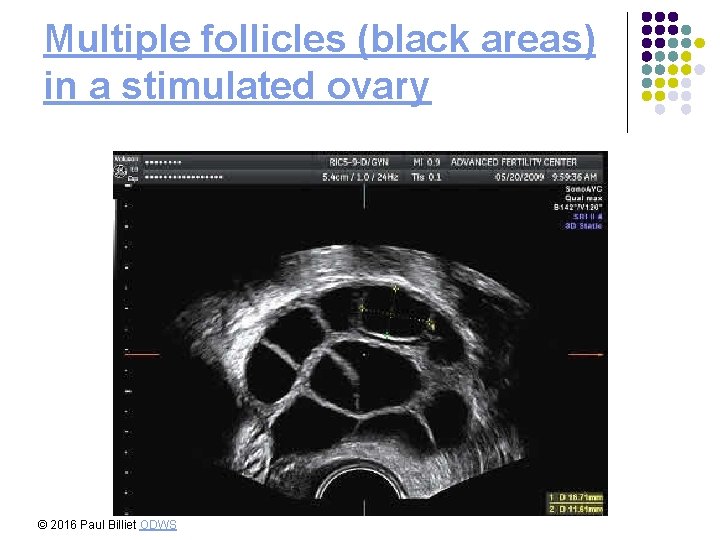 IN VITRO FERTILISATION IVF 2016 Paul Billiet ODWS