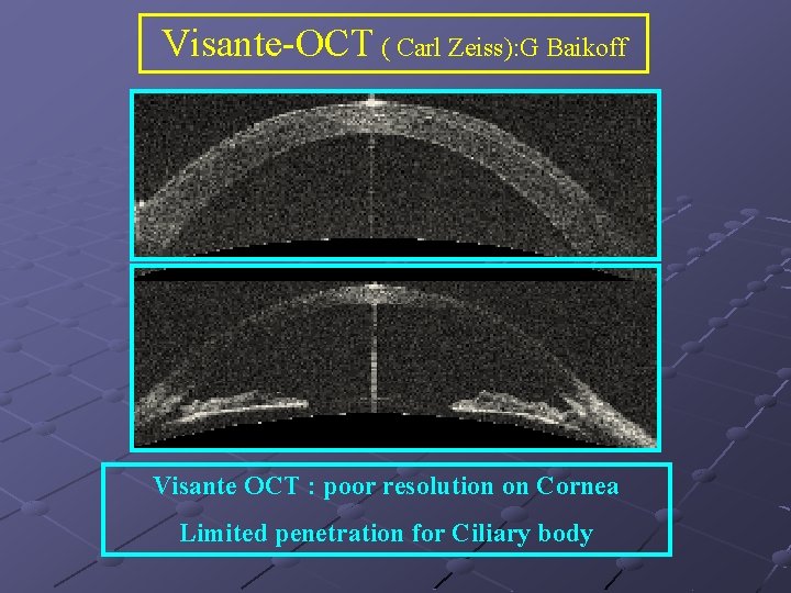 50 MHz Aviso Linear probe in anterior segment