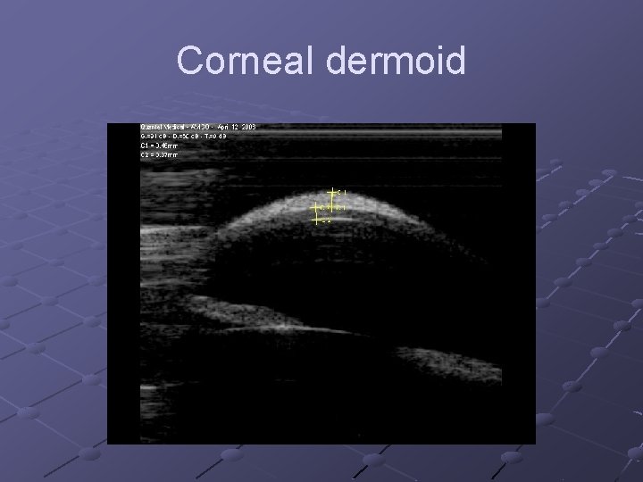 50 MHz Aviso Linear probe in anterior segment