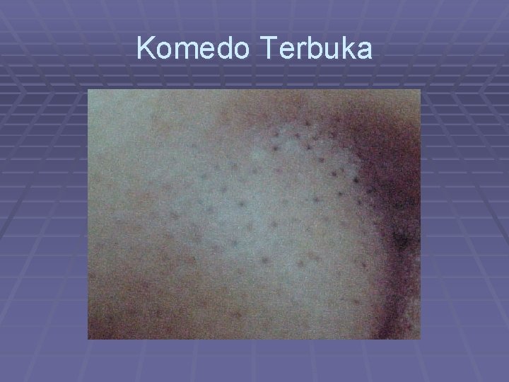 AKNE VULGARIS BATASAN Akne vulgaris peradangan menahun folikel