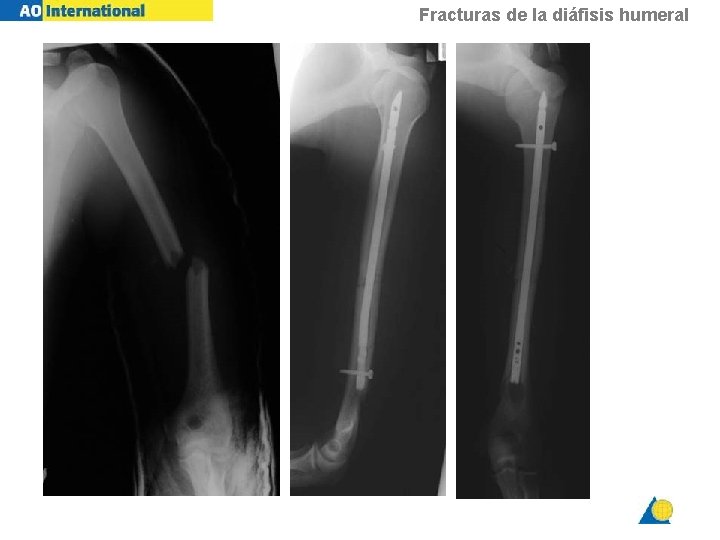 Fracturas de la difisis humeral Fracturas de la