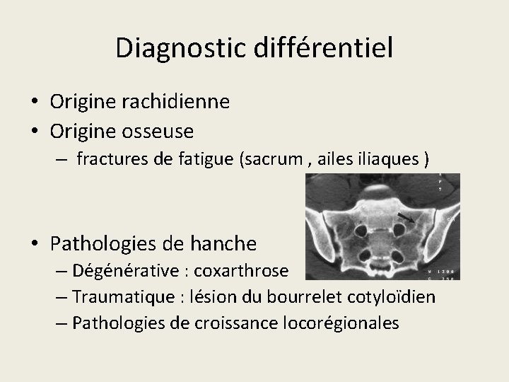 Le syndrome du piriforme chez le coureur pied