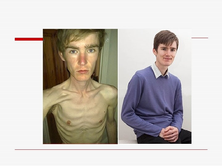 Anorexia Features and Symptoms Have a look at