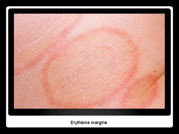 LES SYNDROMES POSTSTREPTOCOCCIQUES Dr H Hadjaissa INTRODUCTION ...