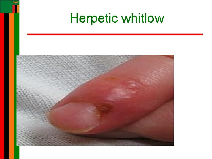 VIRAL SKIN CONDITIONS THE MULAS MANSA SCHOOL OF