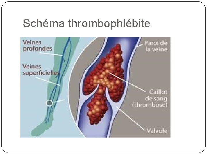 La thrombophlbite des membres inferieurs objectifs A la
