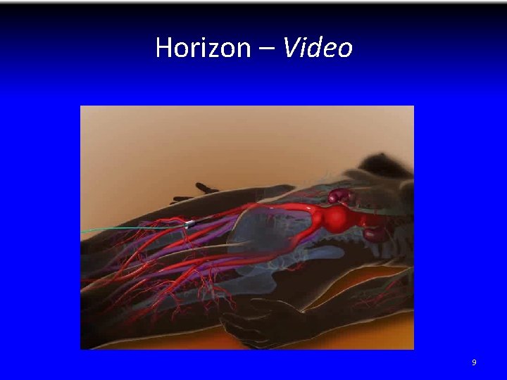 The Endospan Solution for AAA Jacob Cynamon MD